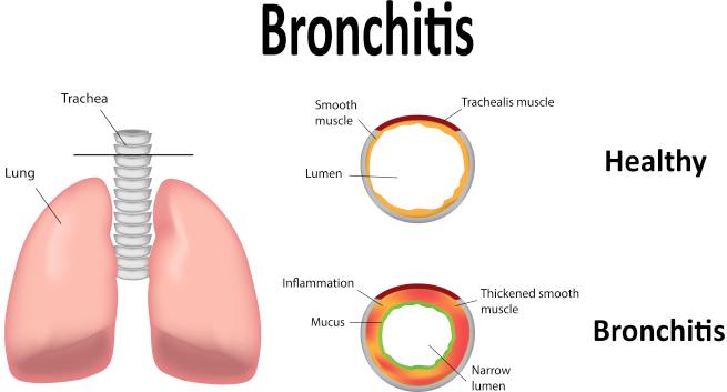 Bronchitis Remedies: Relief from Respiratory Systems Diseases and ...